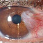 El pterigion - El blog de Ch Salud